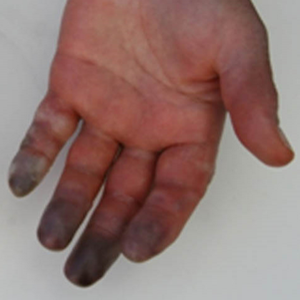 What Is Frostbite And What Does It Do To Your Body? (Video ...